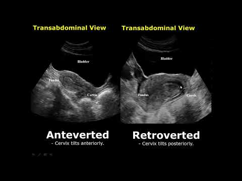 Uterine Positions In Ultrasound | Anteverted/Retroverted | Anteflexed/Retroflexed Uterus