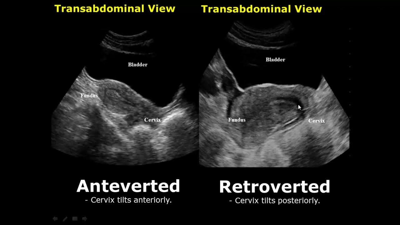Uterine Positions In Ultrasound | Anteverted/Retroverted | Anteflexed/Retroflexed Uterus