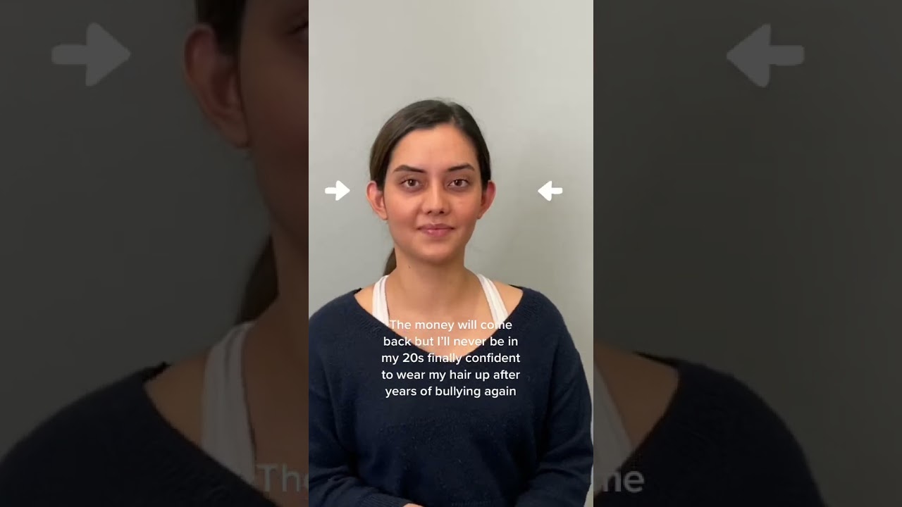 Ear Pinning Surgery BEFORE & AFTER #plasticsurgery #otoplasty #earpinning #beforeandafter