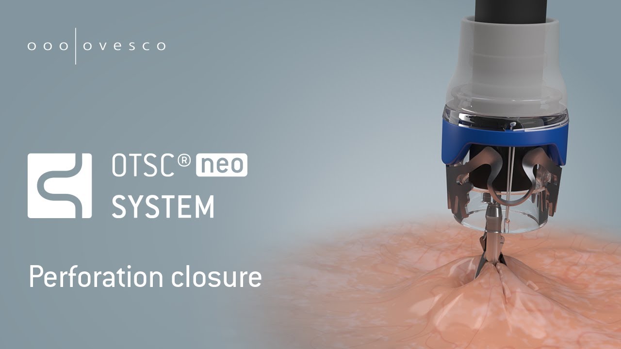 OTSC®neo | Perforation closure