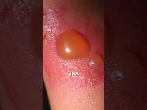 What Are the 3 Main Types of Burn Injuries?