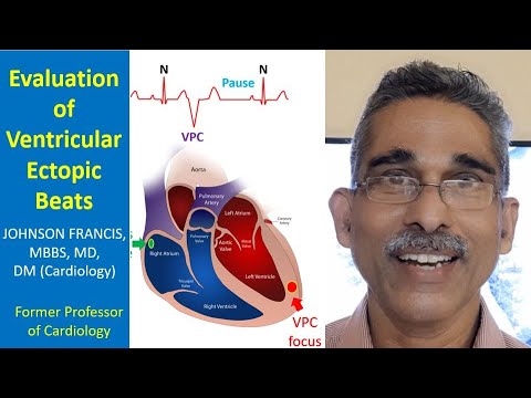 Evaluation of Ventricular Ectopic Beats