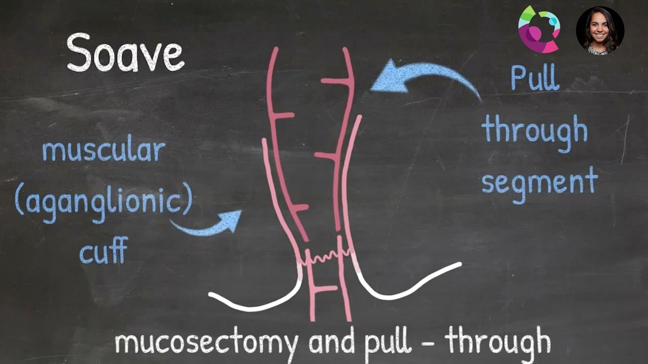 Anatimations: Surgical Options for Hirschsprung Disease