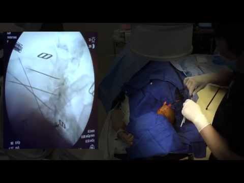 WATCH a Cervical Radiofrequency Ablation - LIVE!