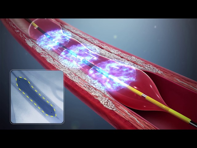 Translumina Products - Translumina Optima Nc Balloon Exporter from Raipur