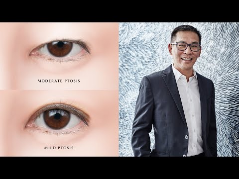 Ptosis Correction for Droopy Eyelids | Dream Aesthetics & Plastic Surgery