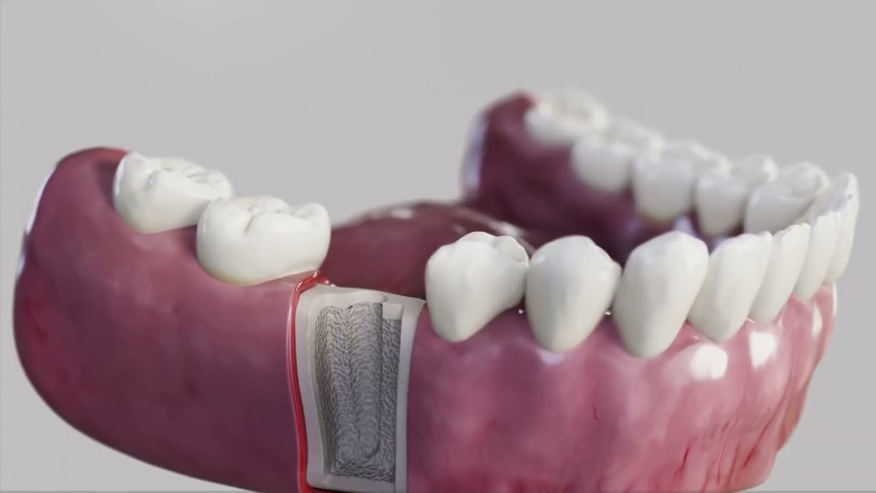 Mastering the DESS® CONICAL BLT Implant Surgical Protocol