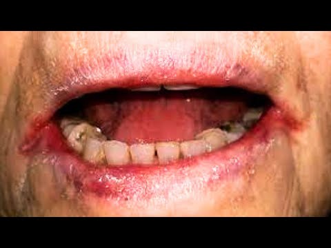 What is Angular Cheilitis? Symptoms, Causes, Treatment