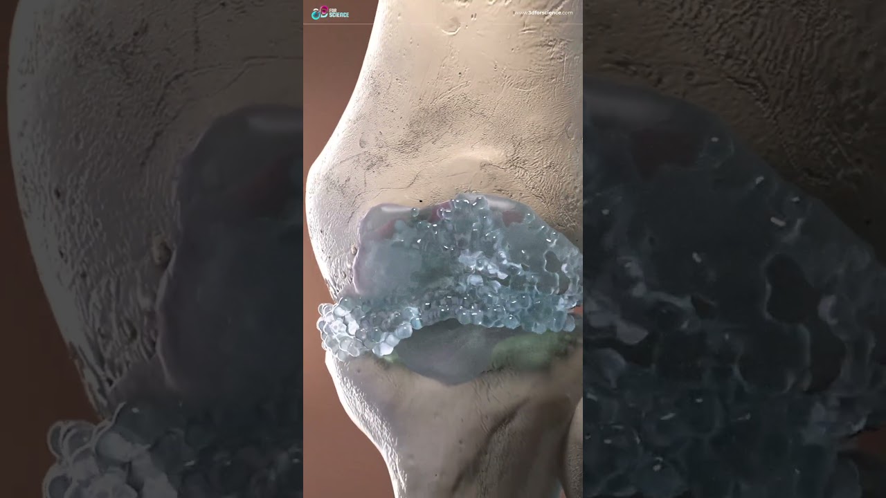 3DforScience Osteoarthritis video