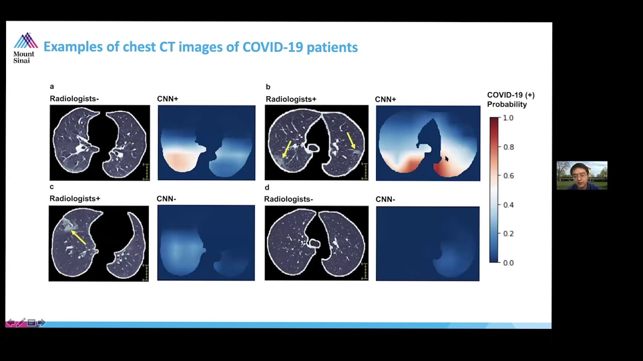 THRIVE Artificial Intelligence-Enabled Rapid Diagnosis of COVID-19 Patients