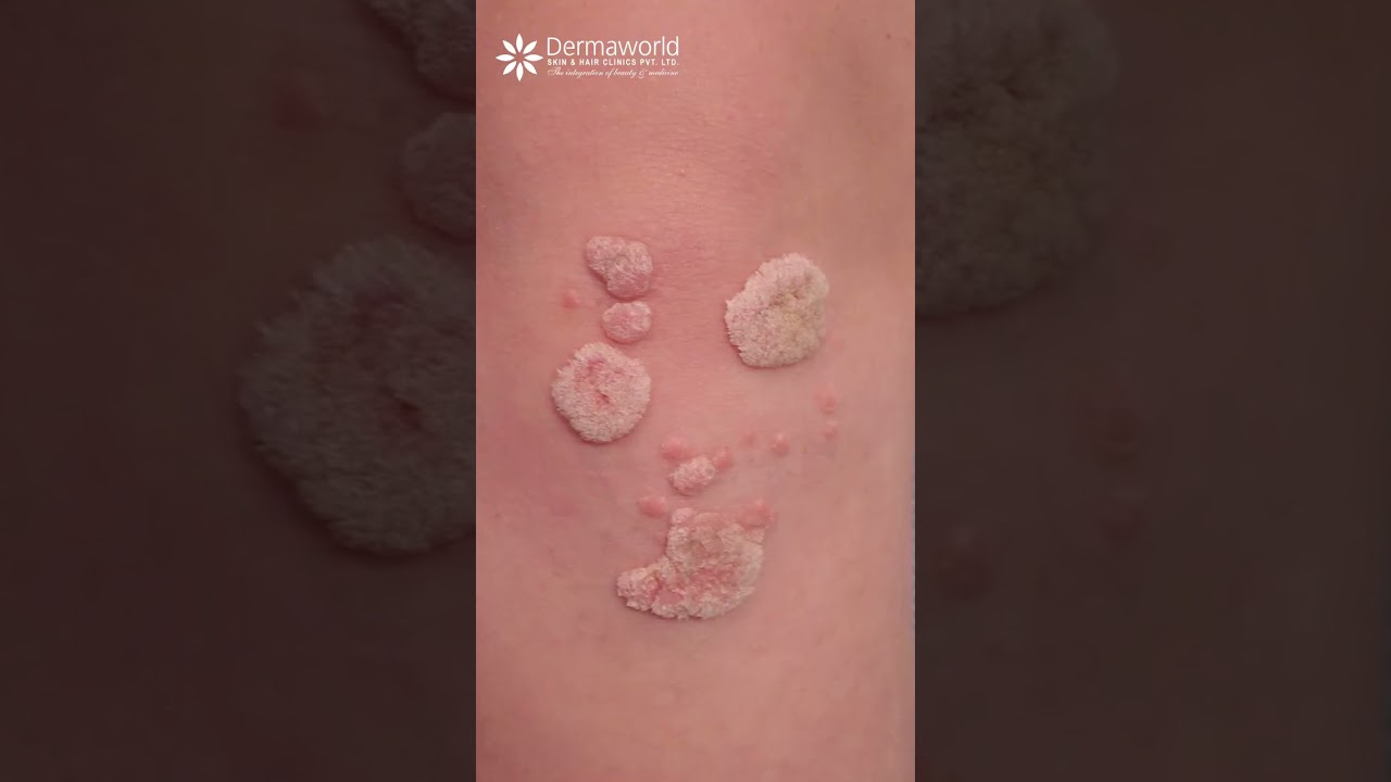 Flat Warts (Verruca Plana) – Causes, Treatment & How to Prevent Them!