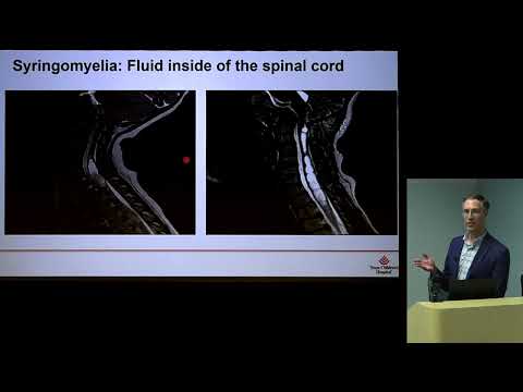 What to Know About Chiari 1 Malformation: What is Chiari and Why Do I Have Symptoms? feat. Dr. Bauer