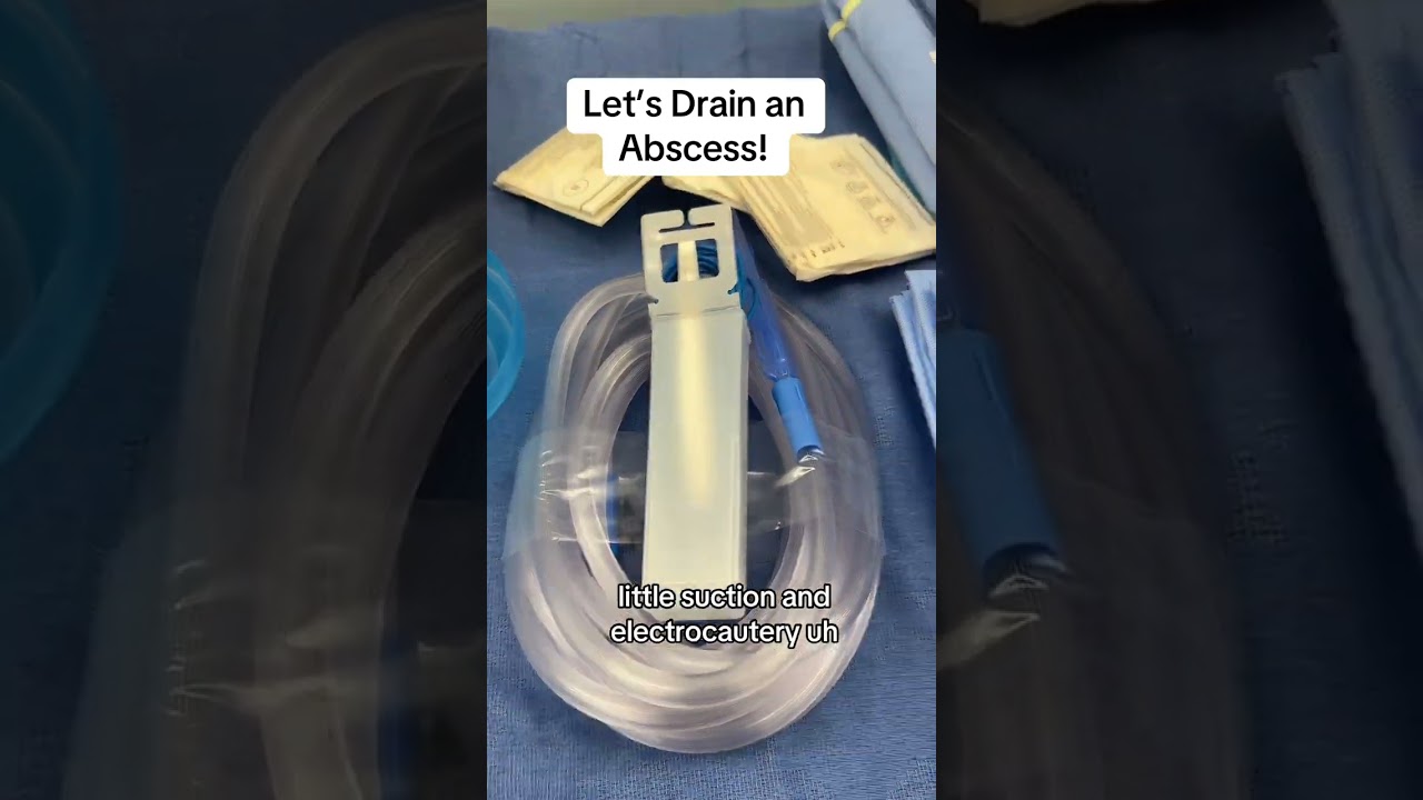 Perirectal abscess drainage.#perianalabscess #analfistula