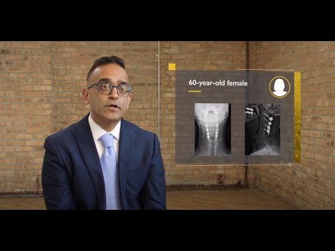 MagnetOs Bone Graft - Clinical experience by Dr. Patel