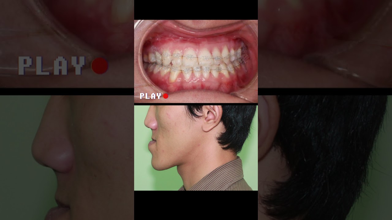 Occlusion Class III braces