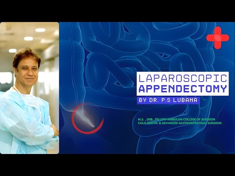 Watch Appendix Removal Laparoscopic Appendectomy Case