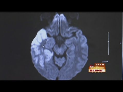 Cryptogenic Strokes