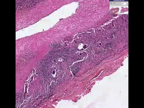 8 Histopathology Temporal artery