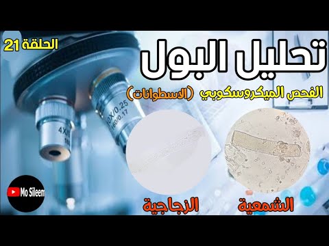 Urinalysis 21 microscopic ex (Hyaline & waxy casts)