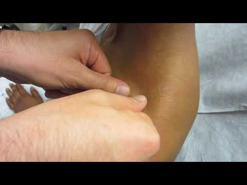 Tinea Versicolor "Fluff Test"