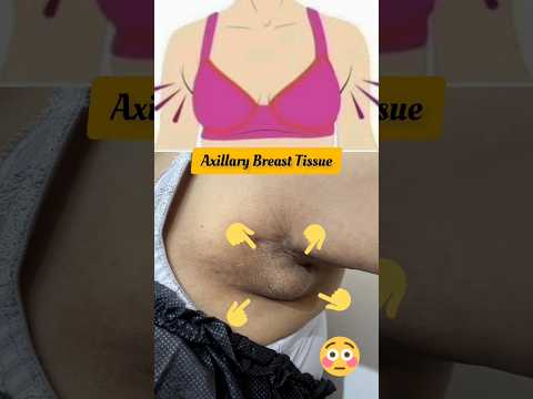 Axillary Breast Tissue | Surgery | Result