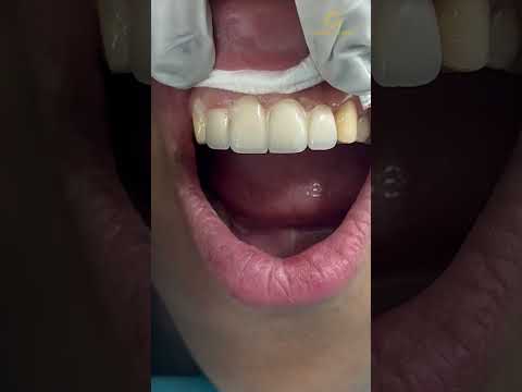 Complete smile transformation using a combination of zircon crowns and veneers