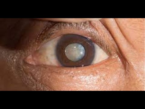 Discission of Cataract surgery CPT code - simplify medical coding