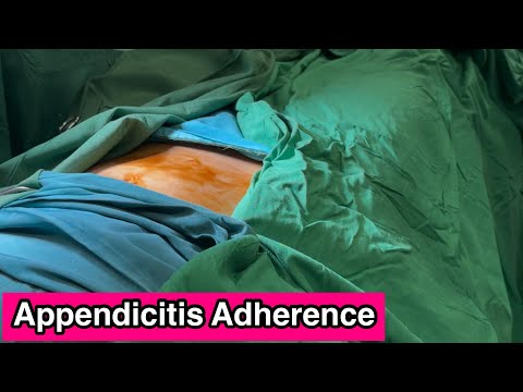 Appendicitis Open Surgery #3 (adherence)
