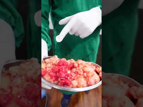 Lipoma | Lipoma Removal | Multipal Lipoma Removal #short #shortvideo
