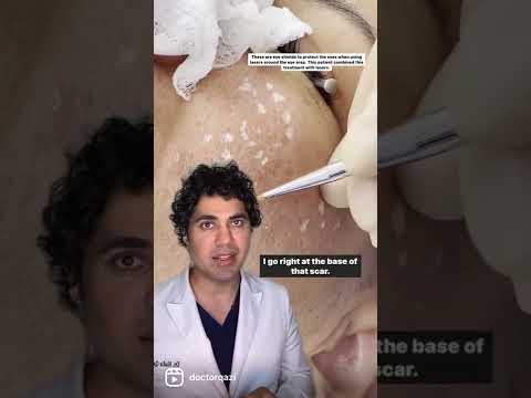 TCA Cross for Treating DEEP *Acne Scars*