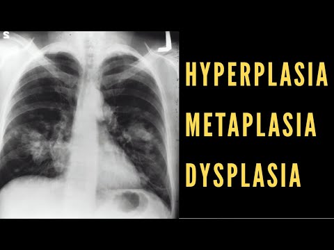 Hyperplasia, Metaplasia & Dysplasia| Explained| Cancer Biology