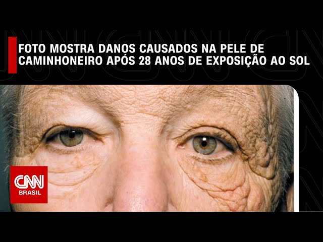 Foto mostra danos causados na pele de caminhoneiro após 28 anos de ...
