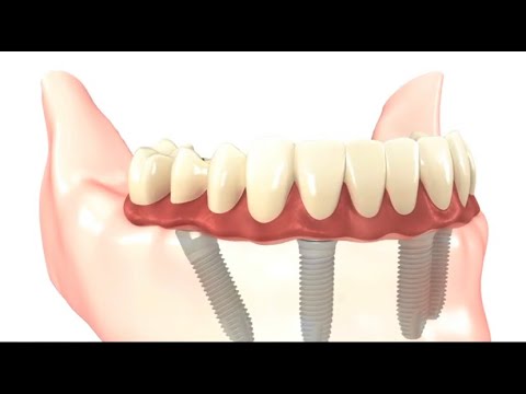 Dr. Goudreau Explains What a Dental Implant is