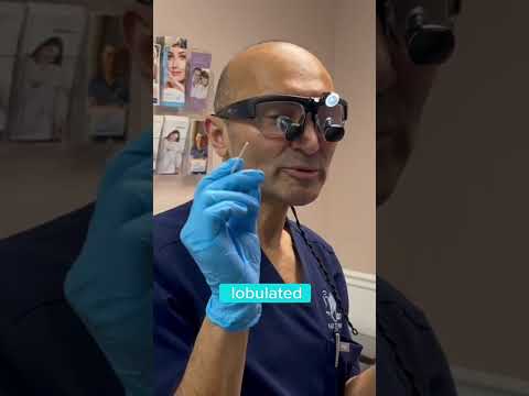 UNUSUAL BUMP IN NOSE - DR. TANVEER JANJUA - NEW JERSEY