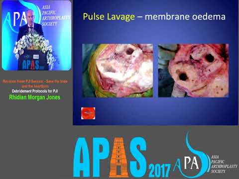 APAS 2017 DAY 2 53 - OrthoTV