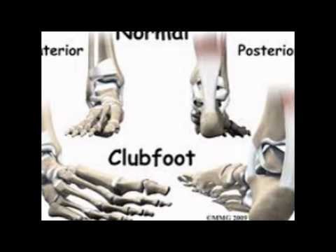 denis browne bar shoes|denis browne boots|w denis browne|talipes equinovarus