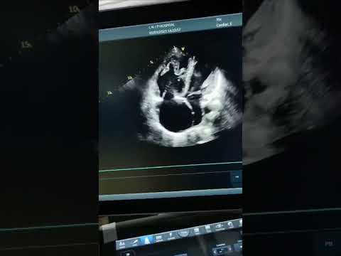 2d echo apical 4 chamber view showing RV dysfunction probably ARVC #cardiology #echocardiography