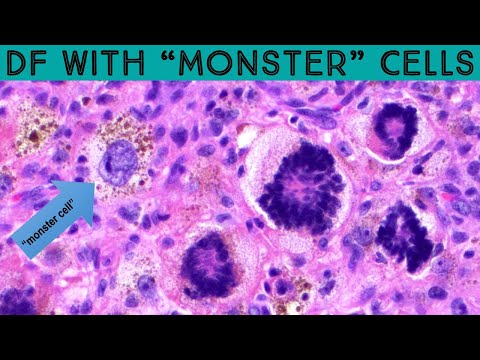 Dermatofibroma with "monster cells" (scary name, benign tumor) dermpath pathology dermatology