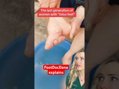 Doctor explains the brutal practice of foot binding