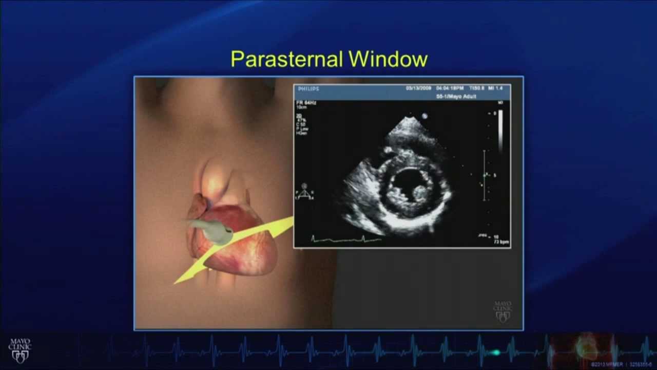 Echo Tutorial: Comprehensive Transthoracic Echocardiogram - Mayo Clinic
