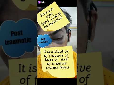 Raccoon eyes#mbbs#neet#neet ug#neet pg.