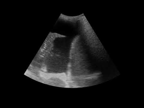 Echographie pulmonaire: Pleurésie avec signe du plancton
