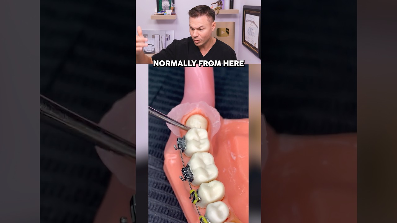 What ACTUALLY Happens In Wisdom Teeth Removal! 😮🦷