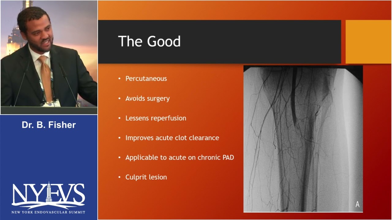 Single Session Thrombectomy vs  CDT for ALI  How do I Choose Bryan Fisher Session III  Acute Limb Is