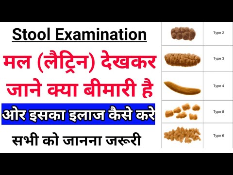 मल (लेट्रिन) को देखकर बीमारी के बारे मे जाने - Stool examination || सभी को पता होना चाहिए