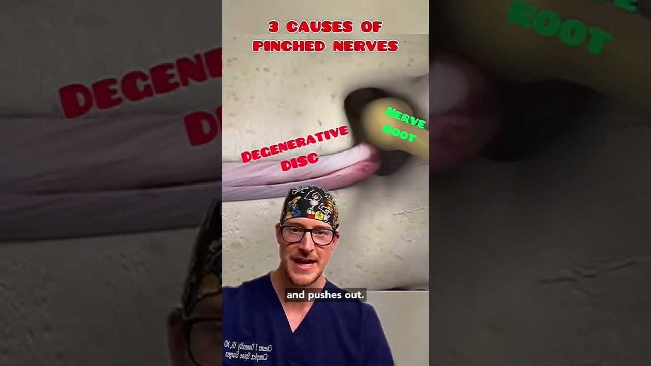 3 Causes of Pinched Nerves (explained by a spine surgeon) 🤓