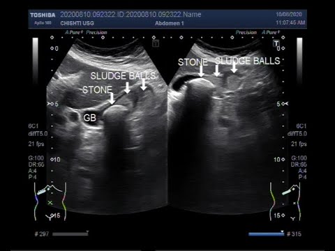 Ultrasound Video showing the Differentiation between Gallbladder stones and sludge balls.