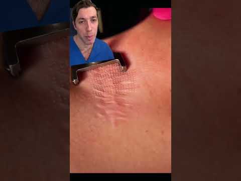 How CO2 Lasers Can Help Smooth Your Skin
