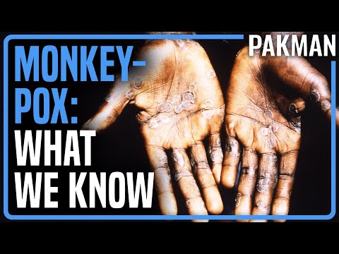 OH NO: Monkeypox Outbreak, Possibly Through Sex