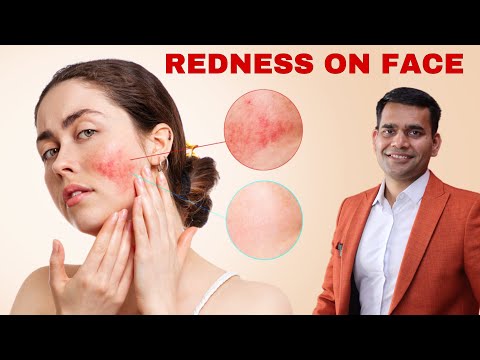 Reduce Redness On Face | Herbs , Diet Plan And Remedies - Dr. Vivek Joshi